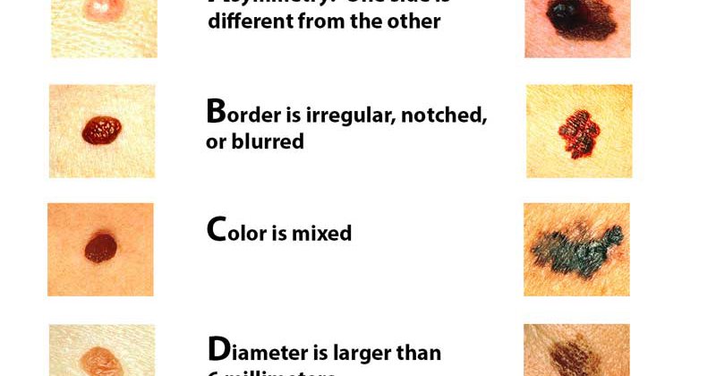 “So I have this mole…" How to identify skin cancer and how to prevent ...