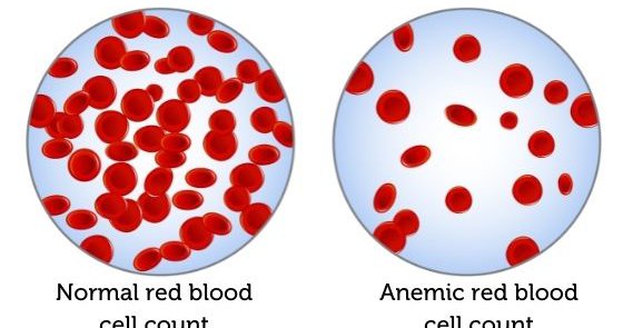Anemia in Seniors: Symptoms, Risk Factors & Prevention | One Medical